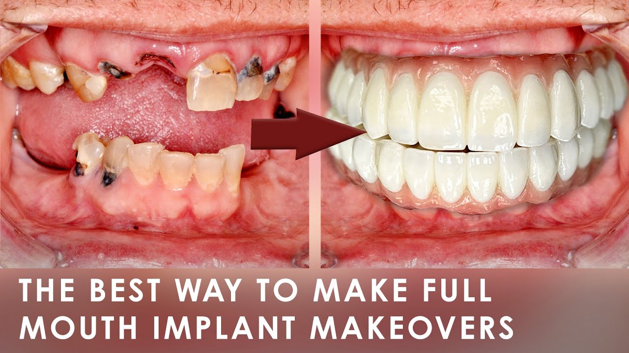 The Best Way to make Full Mouth Implant Makeover Cases - YouTube