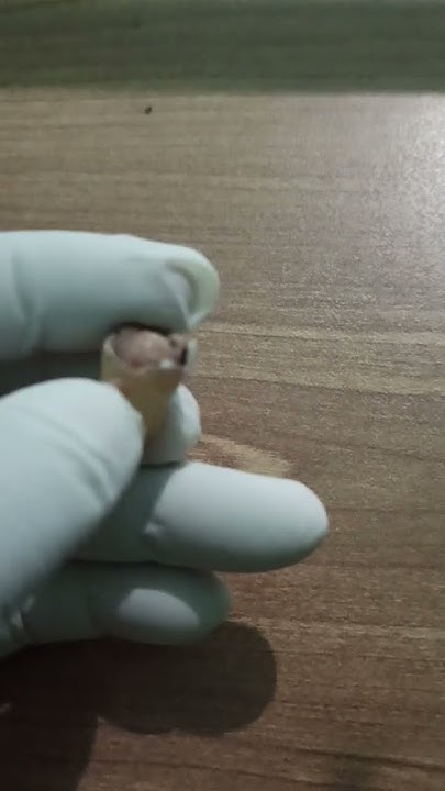 Begini Penampakan Polip Gigi Yang Berhasil Dicabut Bersama Rumahnya Alias Giginya - YouTube