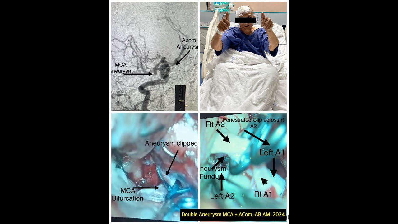 Double Aneurysm Clipping | MCA Aneurysm | ACom Aneurysm | Neurosurgery ...