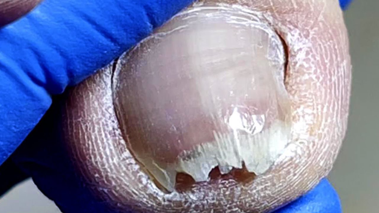 Dry toenails, fully trimmed ingrown toenails #pedicure - YouTube