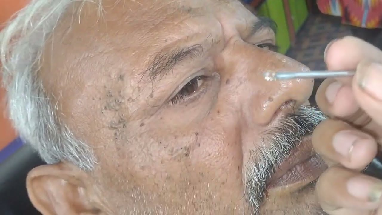 blackheads removal with sac dep spa face treatments | skin cyst face ...