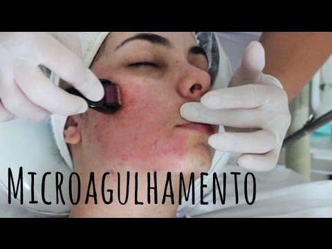 2ª SESSÃO DO MICROAGULHAMENTO - ADEUS CICATRIZES DE ACNE! ~Sweet Carol ...