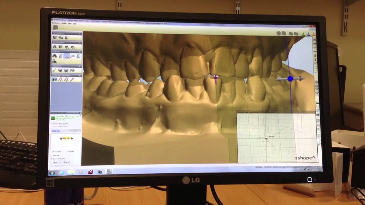 PAR scoring for Orthodontics with ESM: 3Shape model scanner - YouTube