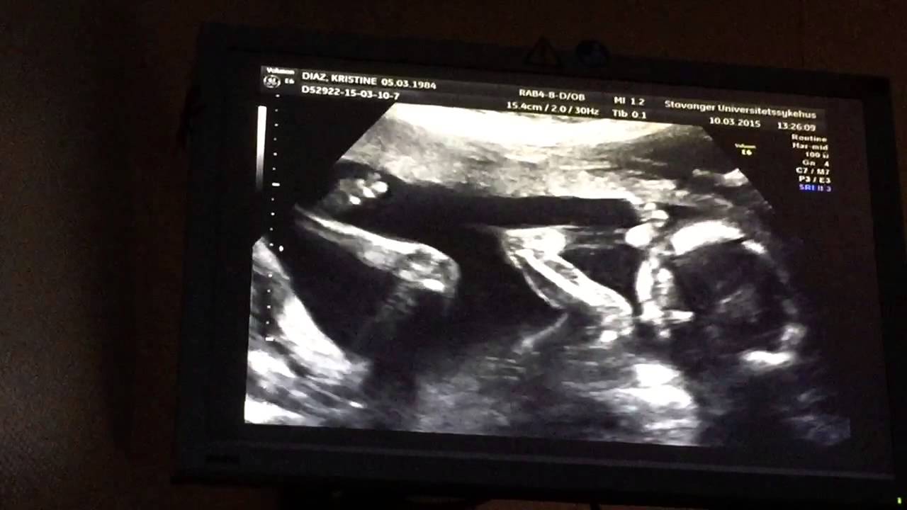 Baby blip blip at 5 months p2 - YouTube