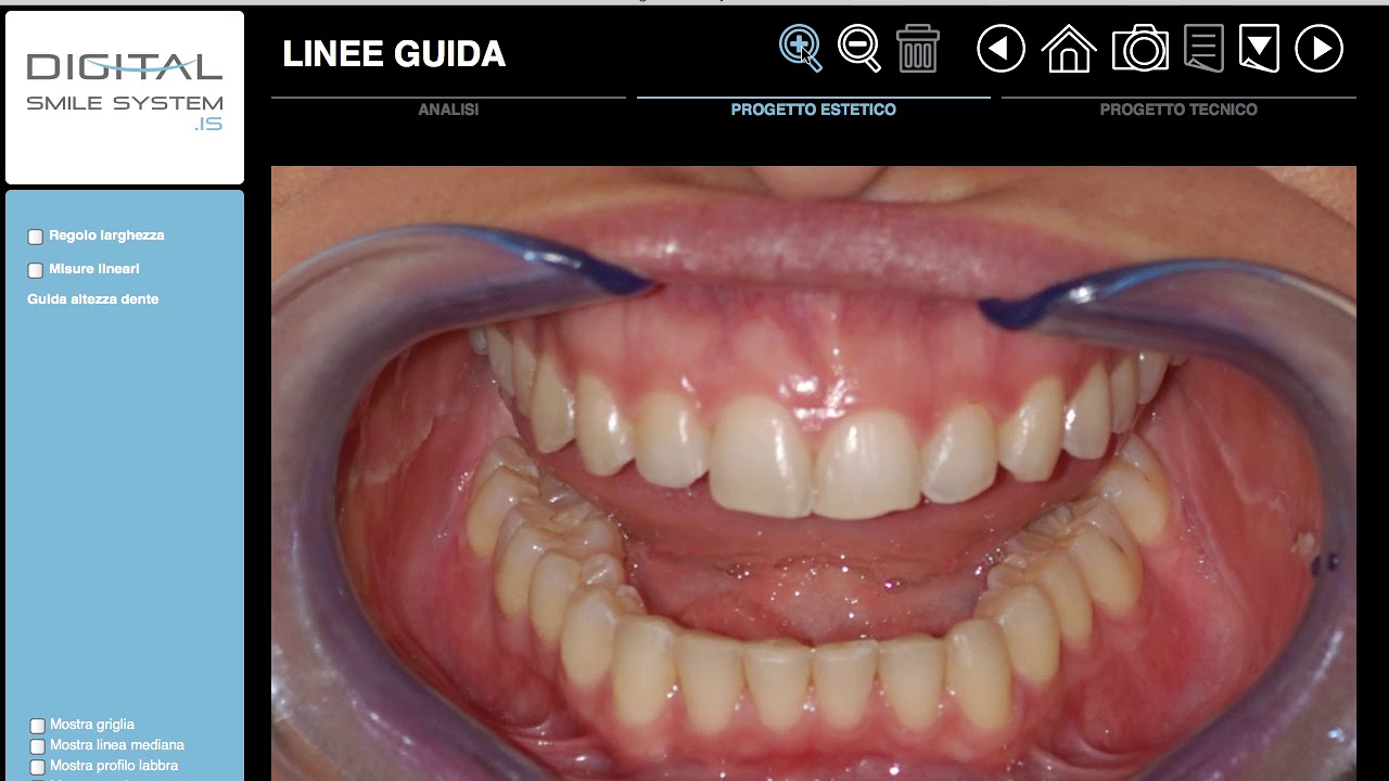 Digital Smile System Perio - YouTube