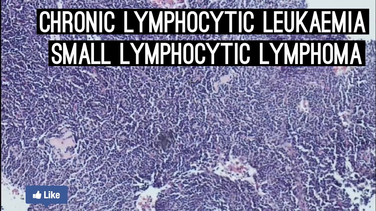 Chronic lymphocytic leukemia/Small lymphocytic lymphoma - YouTube