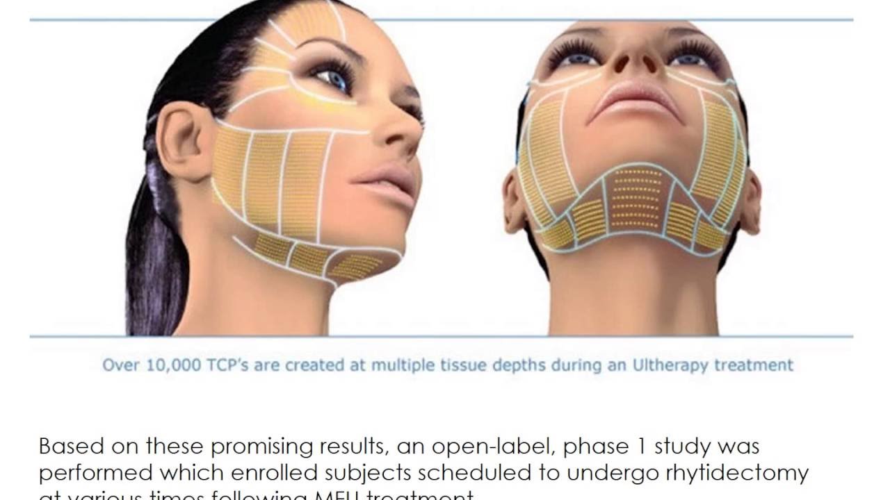 Body Contouring + Skin Tightening (Update on Micro-Focused Ultrasound ...