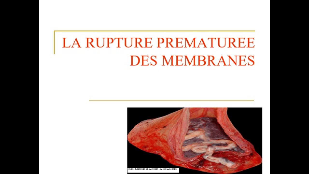 GYNECOLOGIE LA RUPTURE PREMATUREE DES MEMBRANES - YouTube