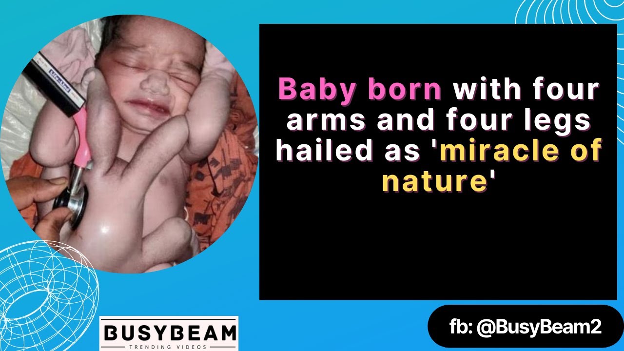 Baby born with four arms and four legs hailed as 'miracle of nature ...