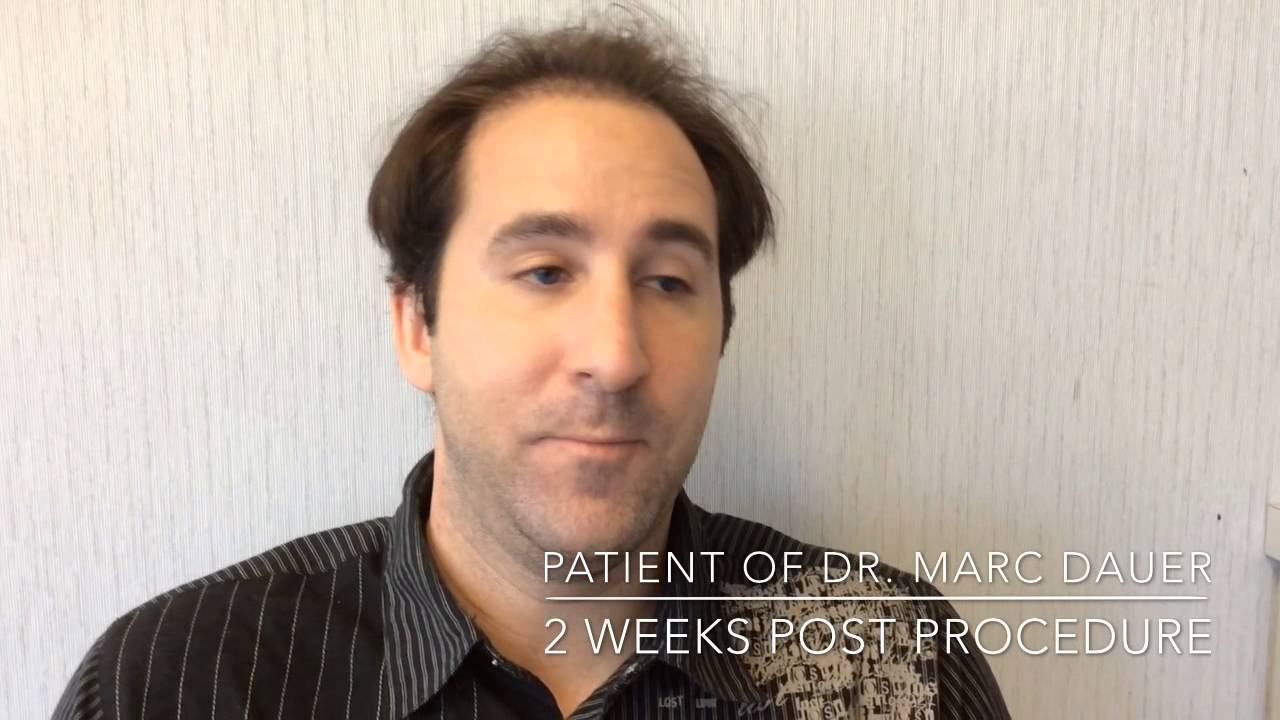 Hair Transplant Testimonial- Patient of Dr. Marc Dauer - YouTube