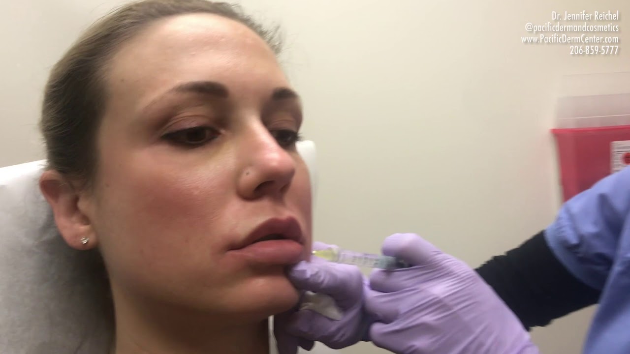 Restylane Defyne Lip Filler Demo - YouTube