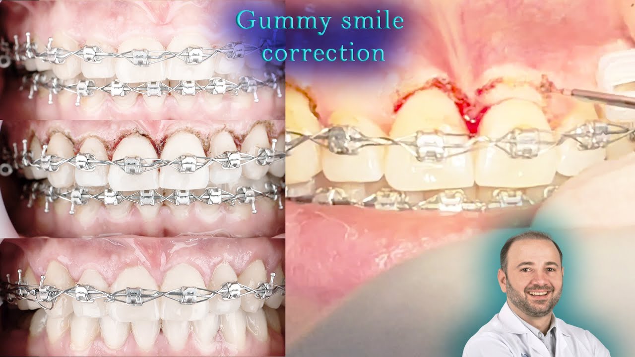 Laser Gingivectomy, gum cutting, contouring gingiva to correct # ...
