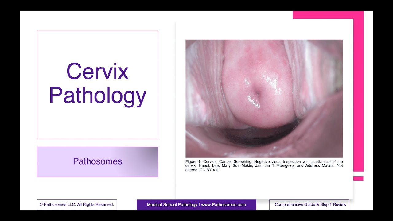 Cervix Pathology | Comprehensive Guide & Step 1 Review | Pathology Step ...