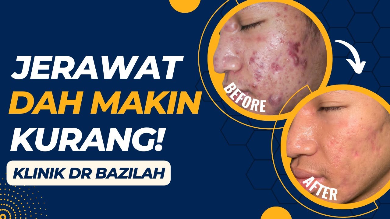 RAWATAN JERAWAT DI KLINIK AESTHETIC KLINIK DR BAZILAH BANGI SHAHALAM ...