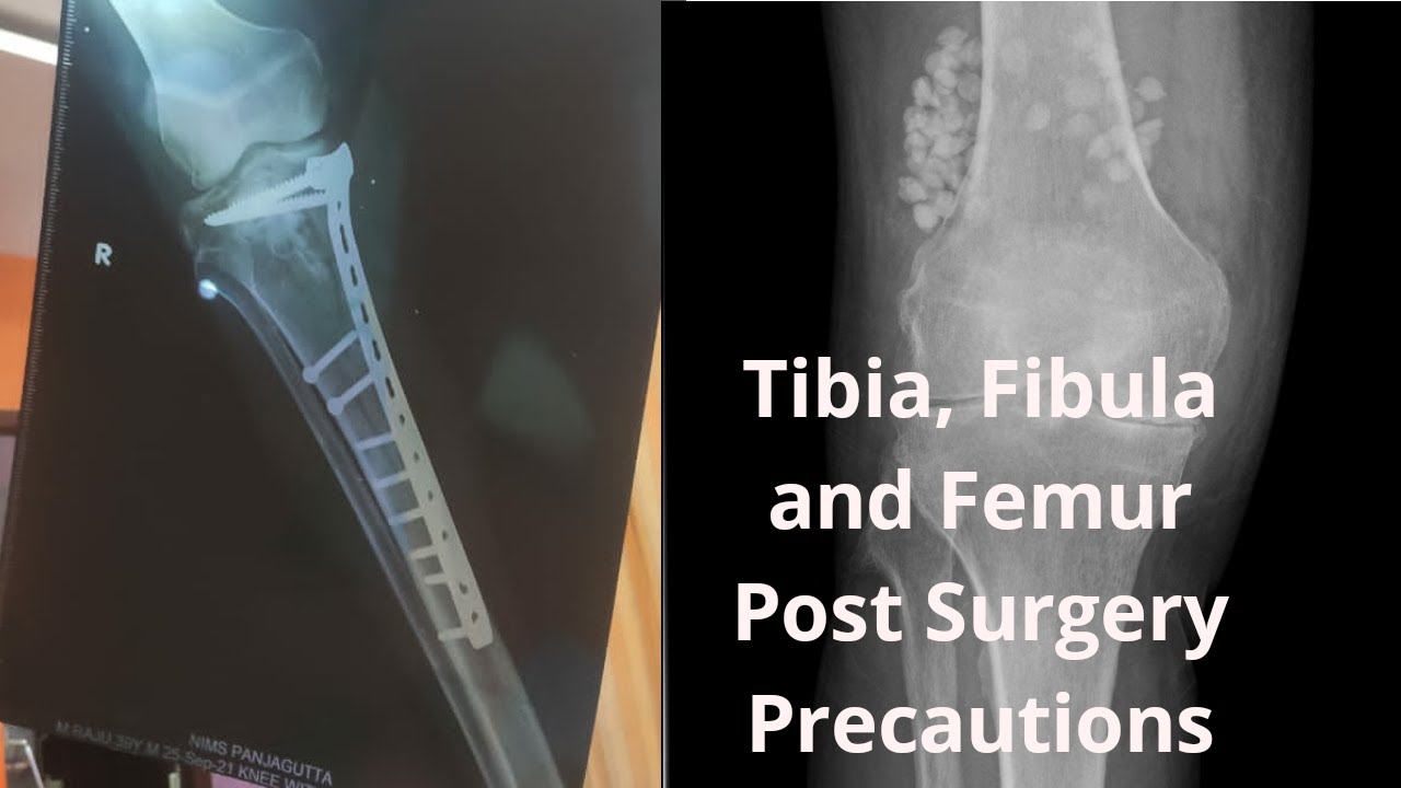 Tibia,Fibula,Femur & Spine Surgery Recovery Tips.टिबिया, फिबुला, फेमूर ...