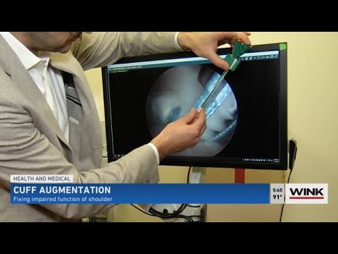 Cuff augmentation helps heal shoulder pain - YouTube