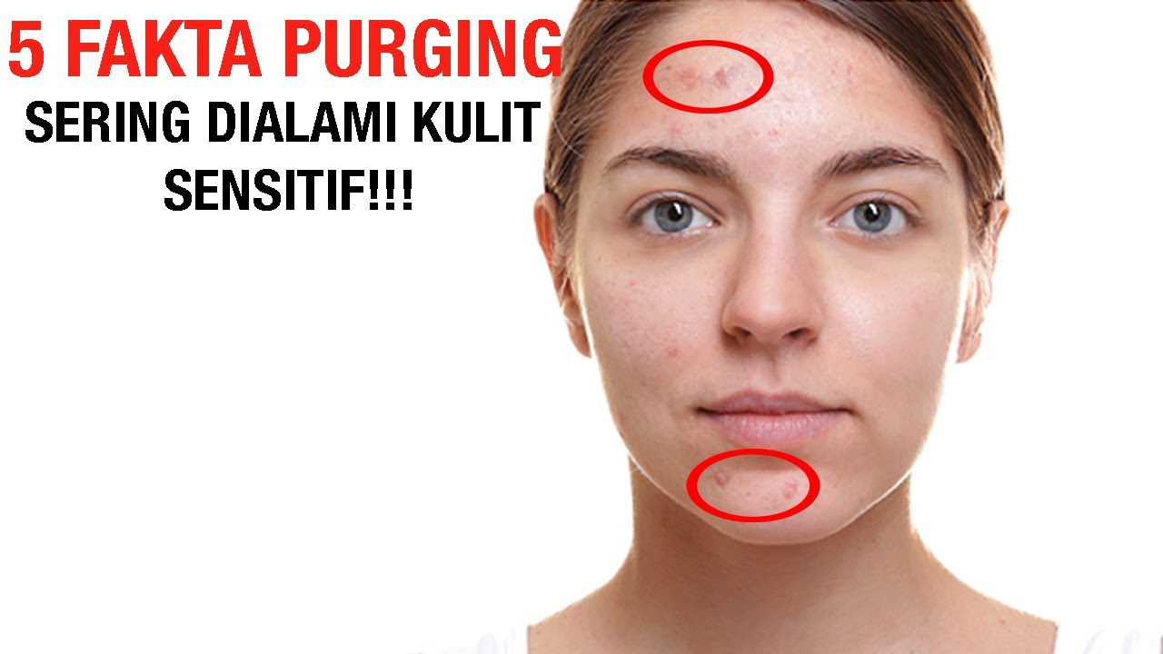 SERING DIALAMI KULIT SENSITIF, Inilah 5 Fakta PURGING. - YouTube