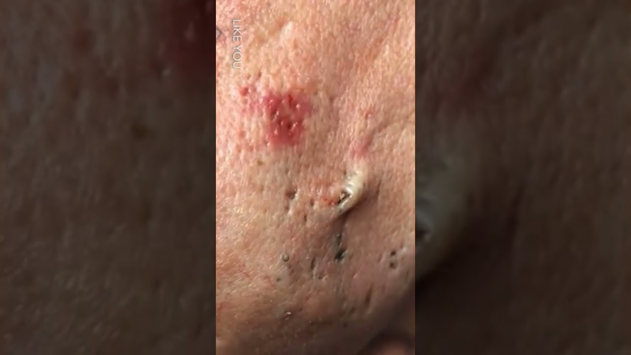 Blackhead Extraction 2021 - YouTube