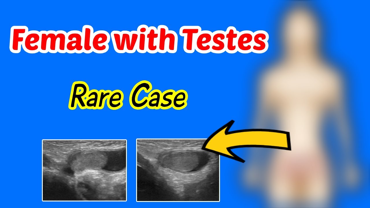 Female with testes (rare case) - YouTube