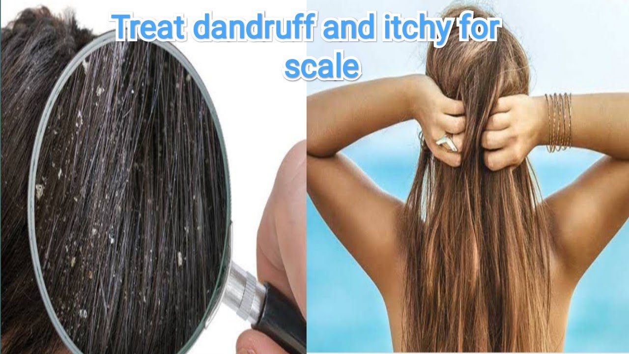 Treat your dandruff and itchy for scale 🙂 - YouTube