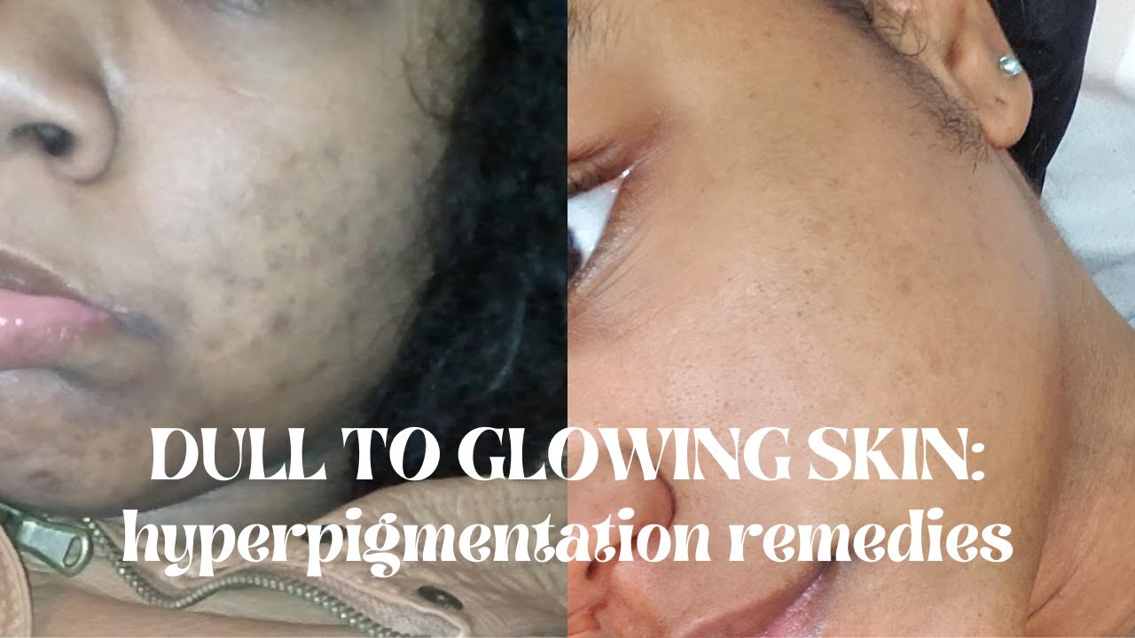 HYPERPIGMENTATION TREATMENT FOR BLACK SKIN | What I used to even my ...