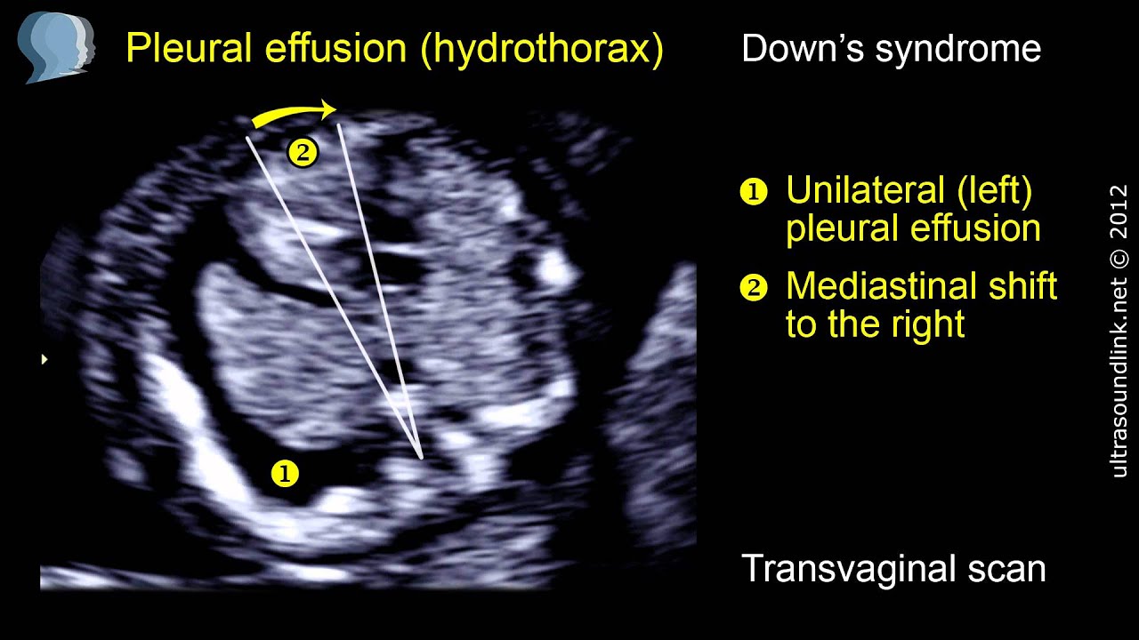 Fetal Pleural Effusion Ultrasound