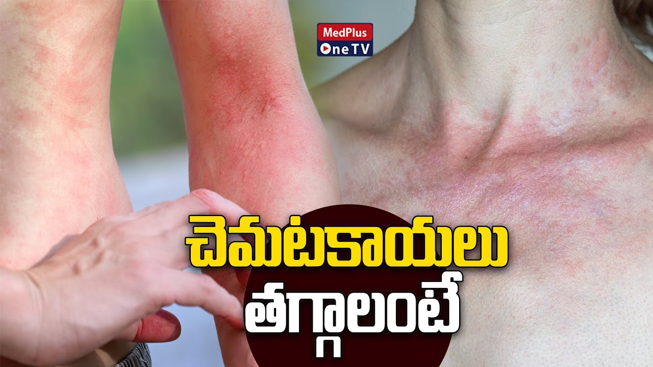 HEAT RASHES : Get Rid of Skin Problems in Summer l Skin Care Tips ...