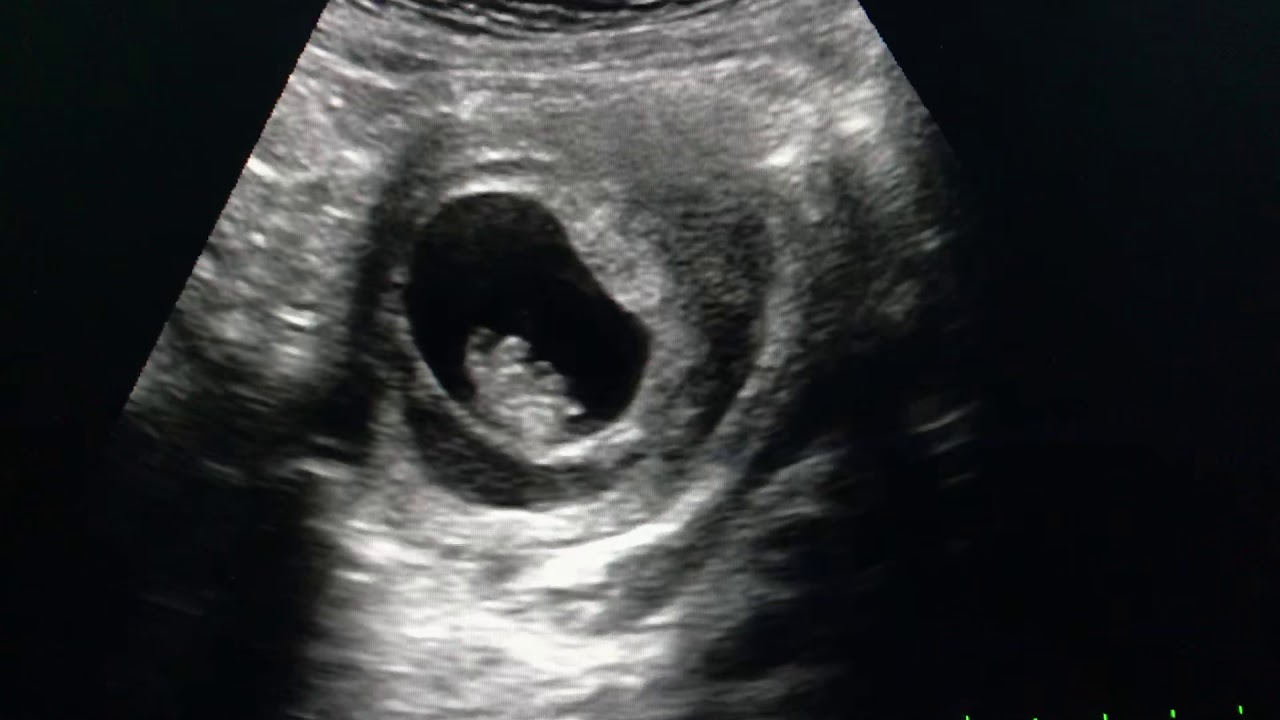 Subchorionic separation USG Ultrasound - YouTube