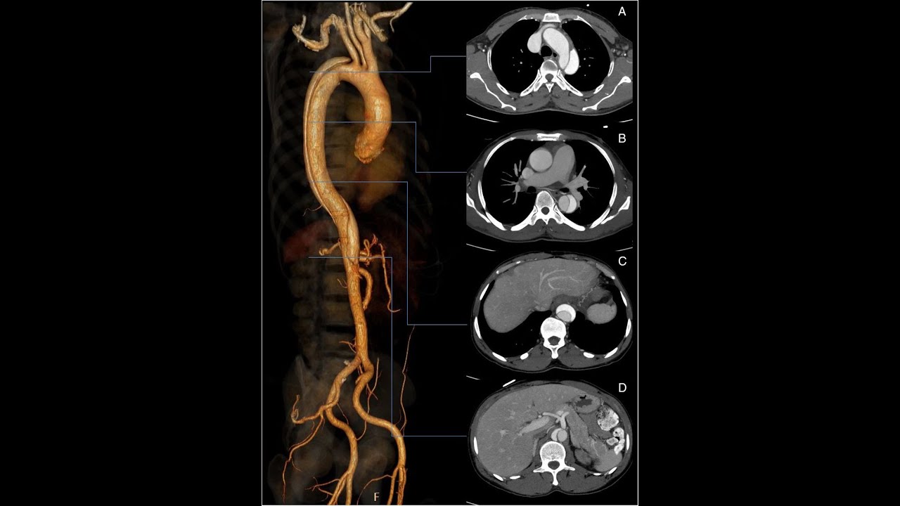 GE ADW AORTOGRAM POST-PROCESSING - YouTube