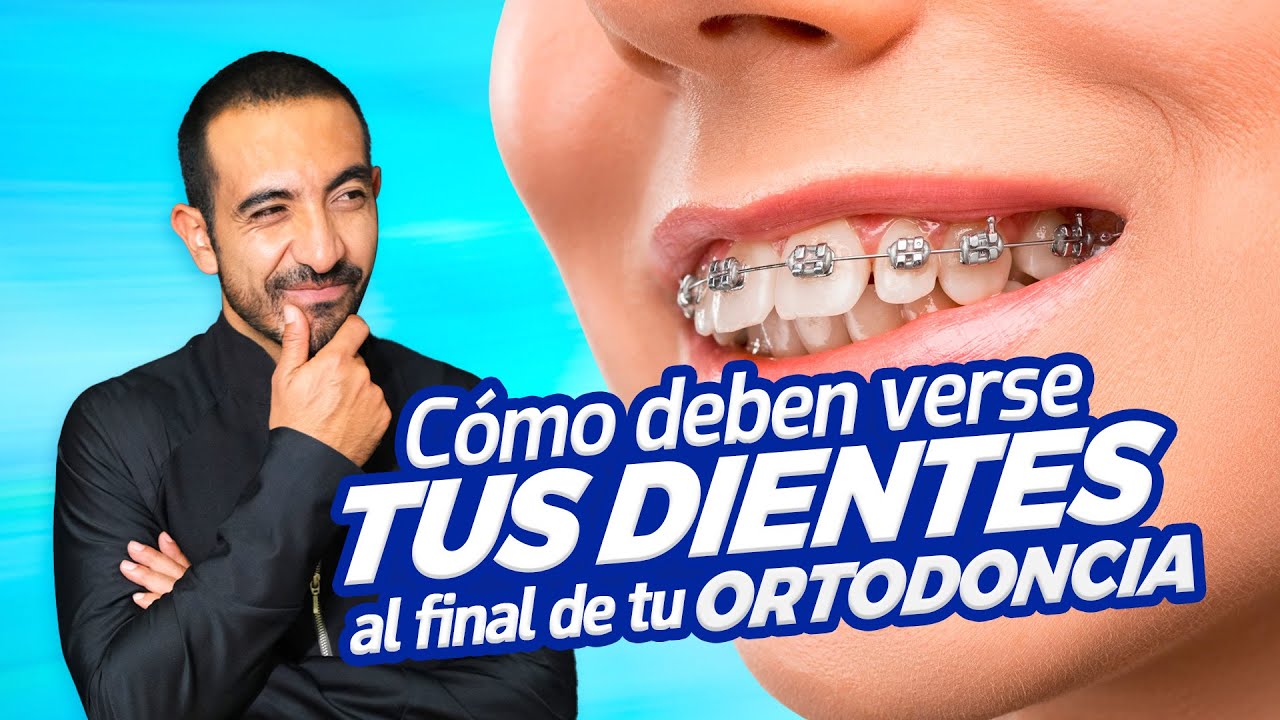 Así Deben Verse Tus Dientes Después de los Brackets - YouTube