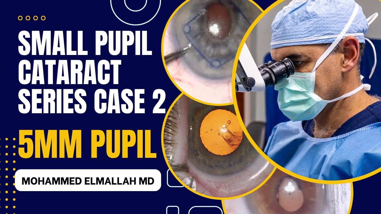 Case 2 Small Pupil Series - 5mm pupil July 2025 - YouTube