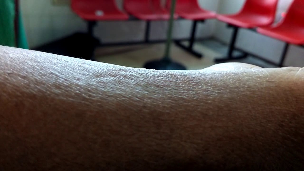 Visible radial pulse - YouTube