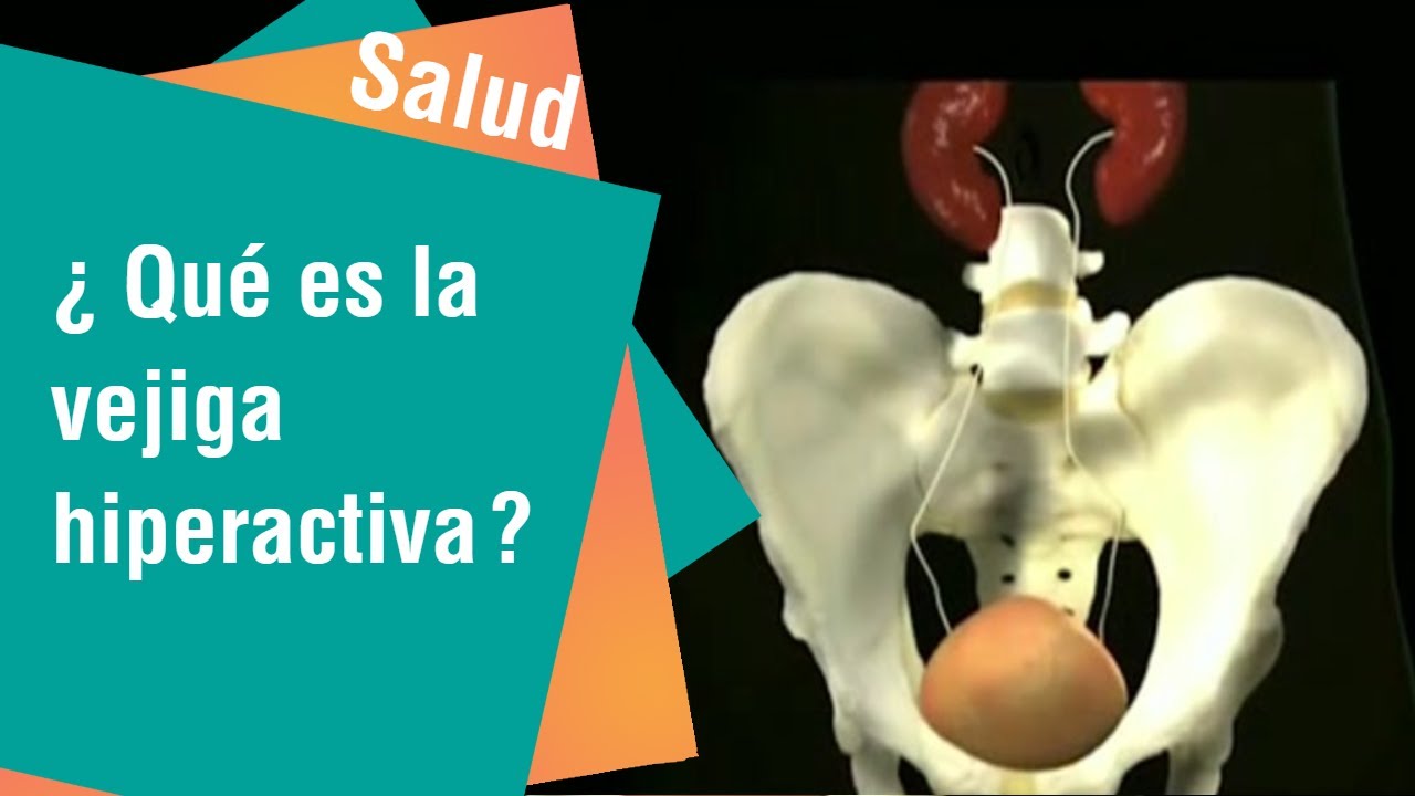 ¿Tiene una VEJIGA HIPERACTIVA? Sepa cuáles son las CAUSAS y TRATAMIENTO ...