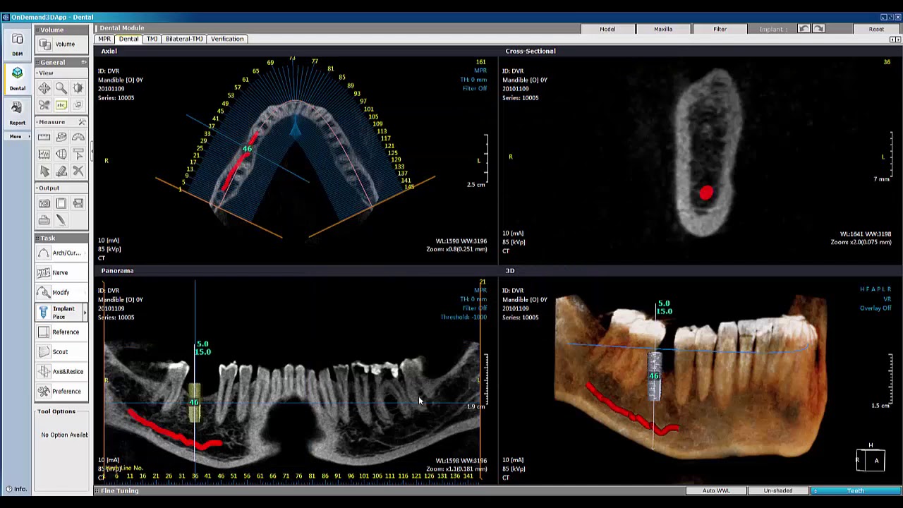 Cybermed OnDemand3D Dental Implant Planning - YouTube