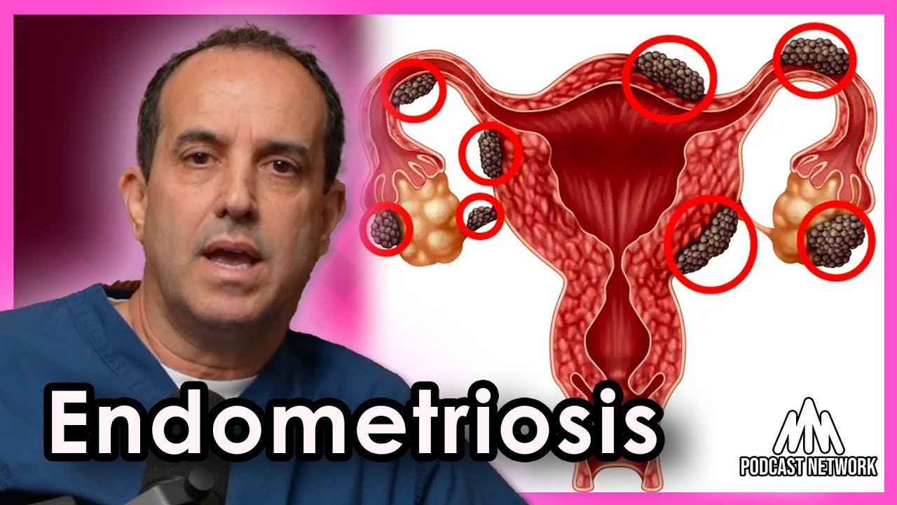 Endometriosis: Causes, Symptoms, & Treatments With Dr. Shaban ...