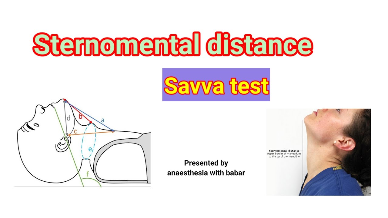 Sternomental distance | SAVVA TEST | SHORT VIDEO ...