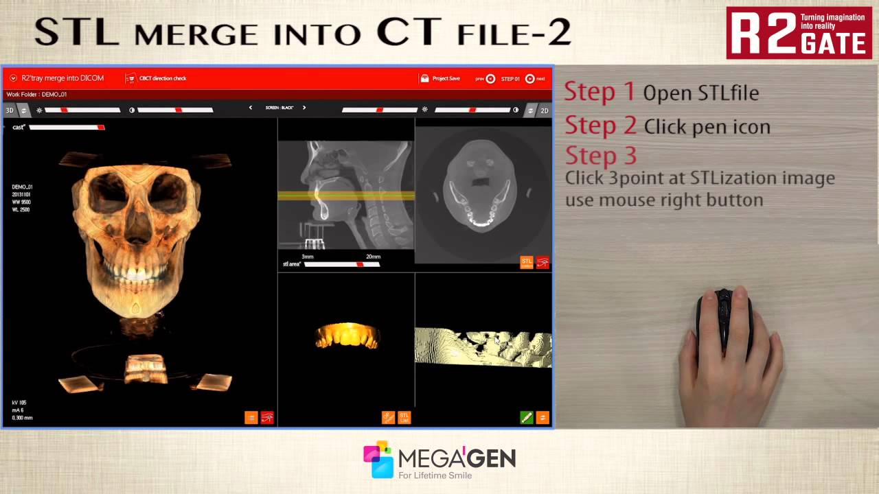 STL merge into CT file 2 - YouTube