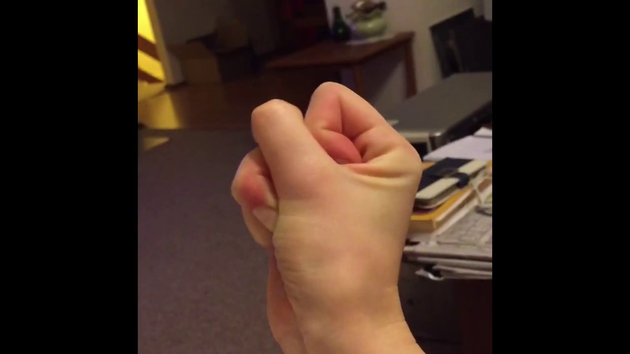 FND Symptoms: Dystonia (clenched hand) - YouTube