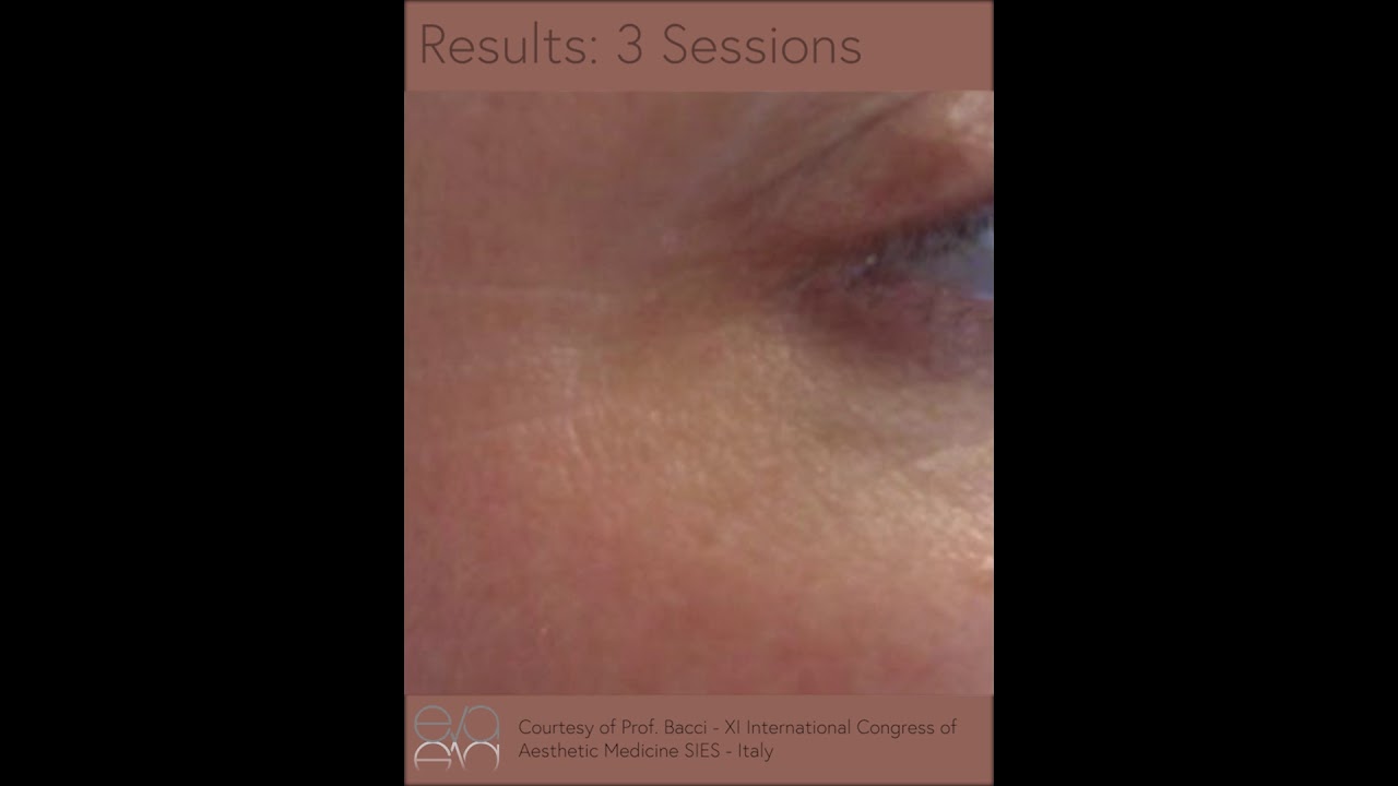 Endospheres Therapy Before and After - YouTube