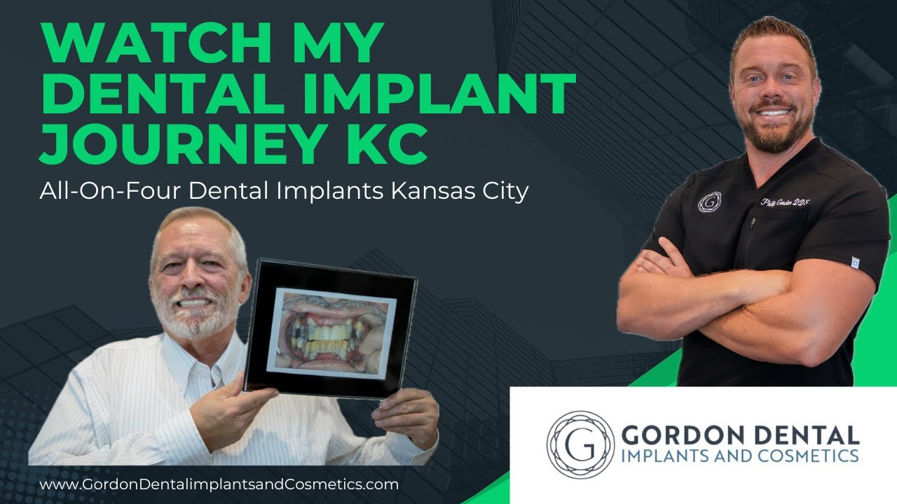 #1 Top Rated Full Mouth Dental Implants Provider in Kansas City Gordon ...