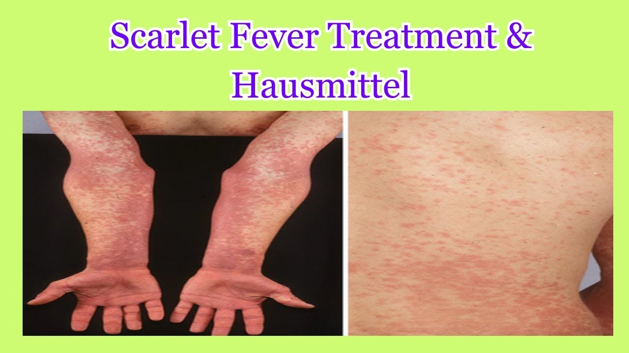 Scarlet Fever Treatment & Hausmittel - YouTube