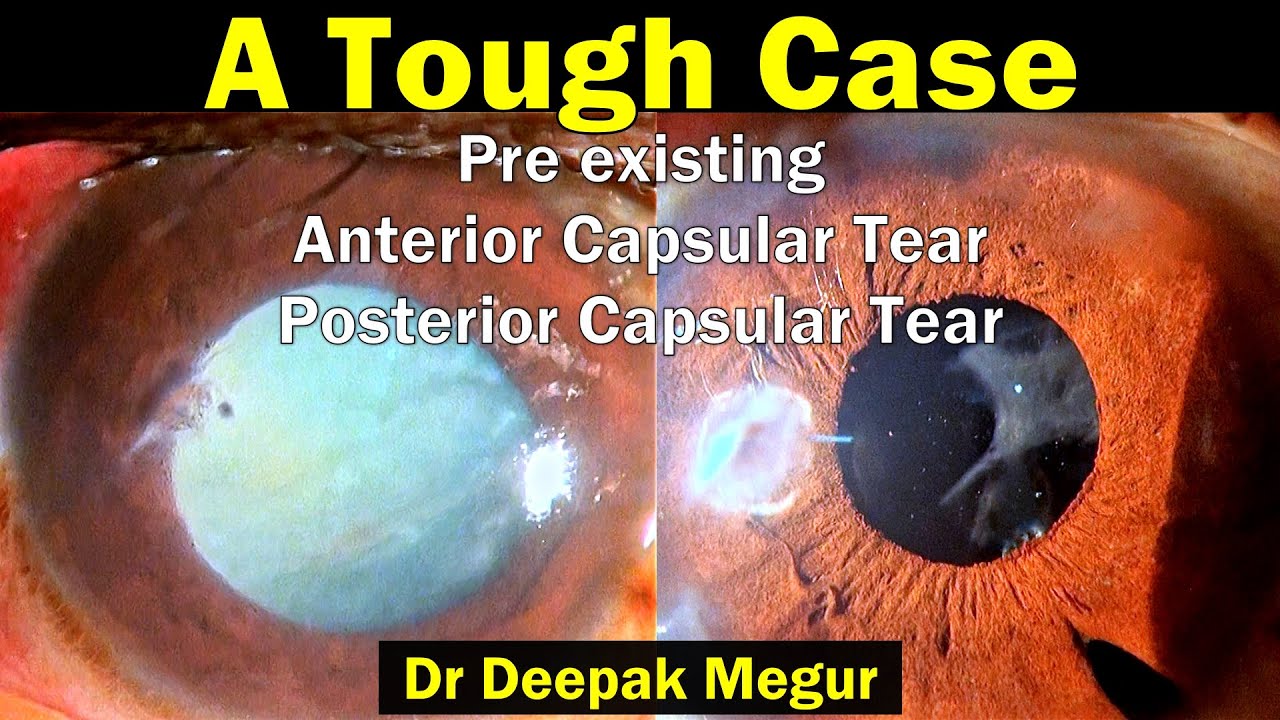 Planning & Execution of a Complex Case:Secondary Glaucoma, Pre-Existing ...