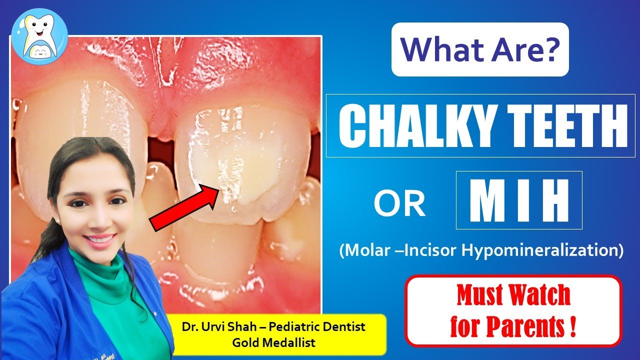 Chalky Teeth I What are Chalky Teeth ? - YouTube