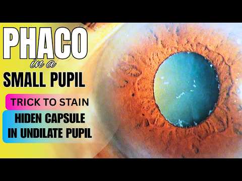 Small pupil phaco : How to stain capsule in small pupil : Dr. Deepak Megur