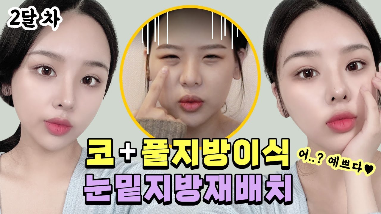성형브이로그 🧡자연스러운 성형🧡 성형 후 여신 강림 코·지방이식·눈밑지 두 달 차 후기 코성형후기 코성형전후 성형
