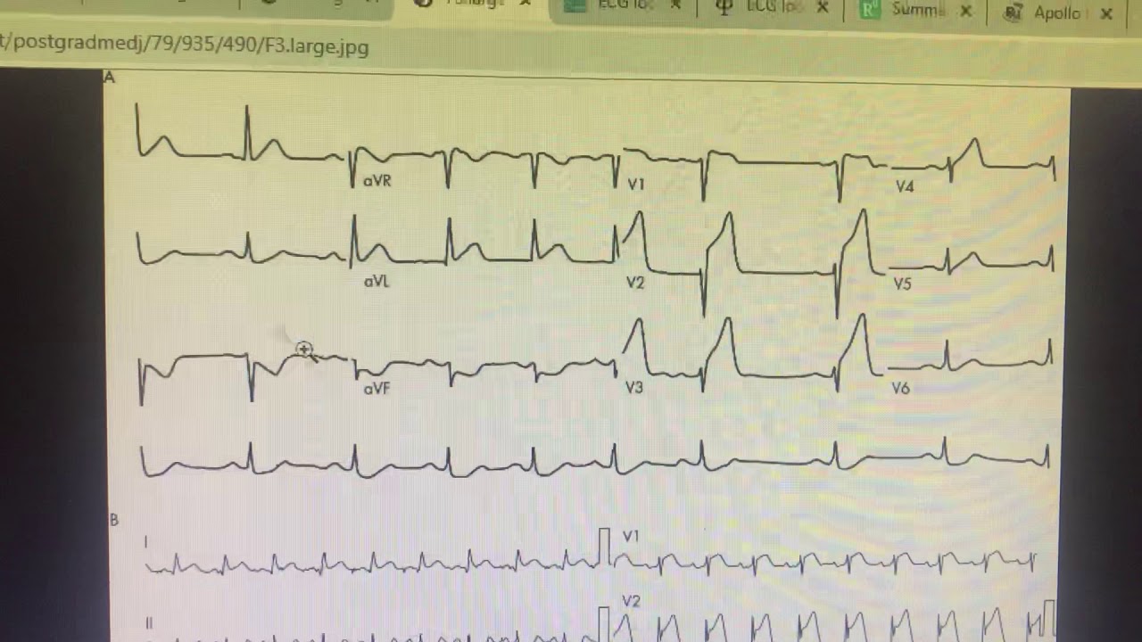 Localization of MI on ecg - YouTube