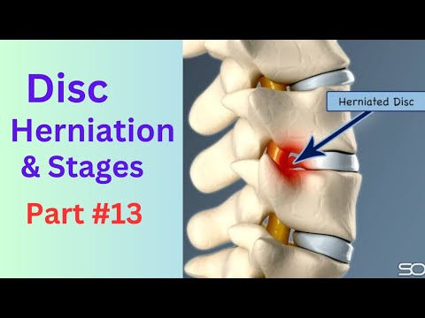 Disc Herniation | Disc slip | Stages of Disc Herniation | Causes ...