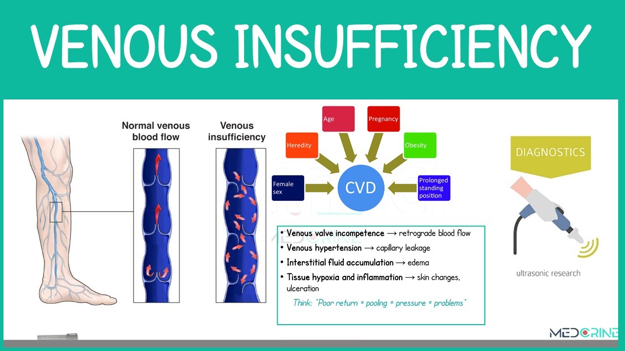 Venous Insufficiency Explained | High-Yield Nursing & Medical Lecture ...