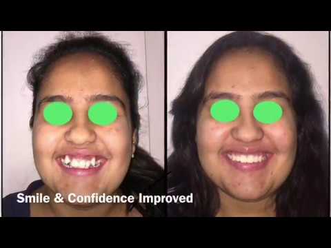 Braces Before and After - Crowding and High Canine Tooth Correction ...