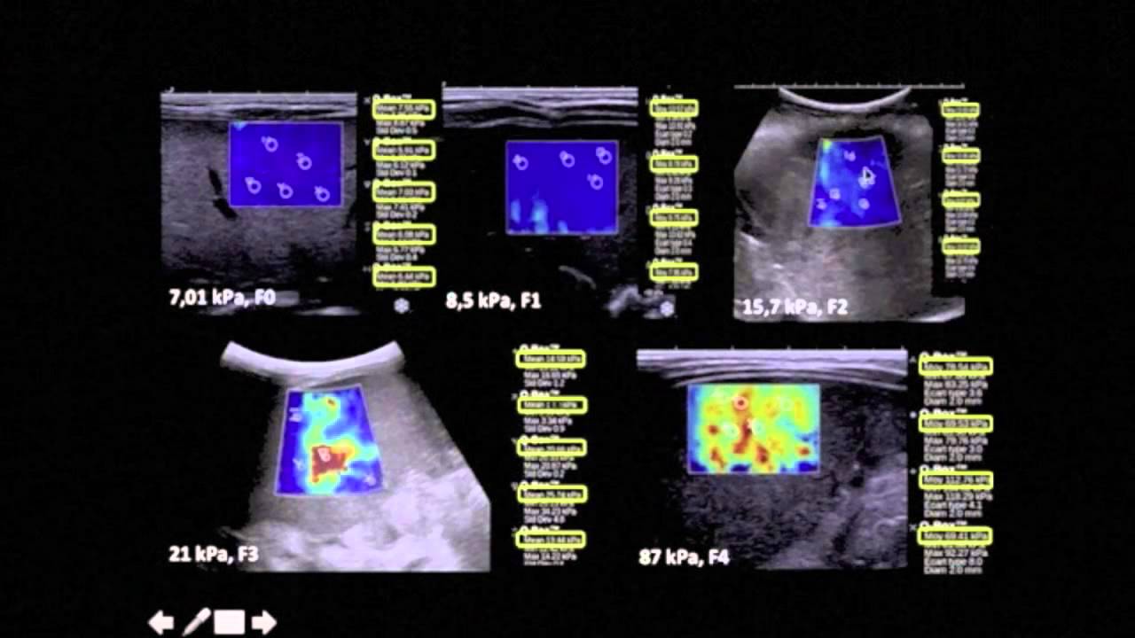 Advantages and Applications of UltraFast™ Doppler : Stéphanie Franchi ...